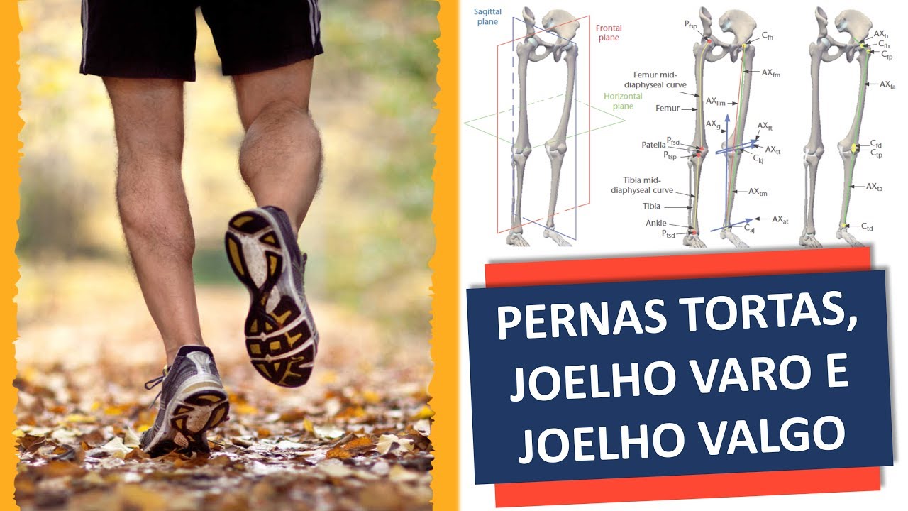 PERNAS TORTAS, JOELHO VARO E JOELHO VALGO - YouTube