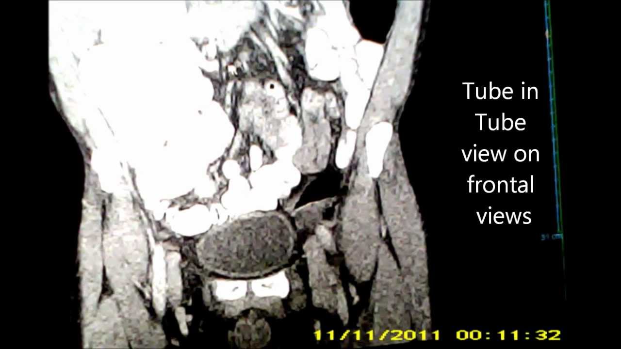 Intussusception on CT Scan Practical Review Target Sign - YouTube