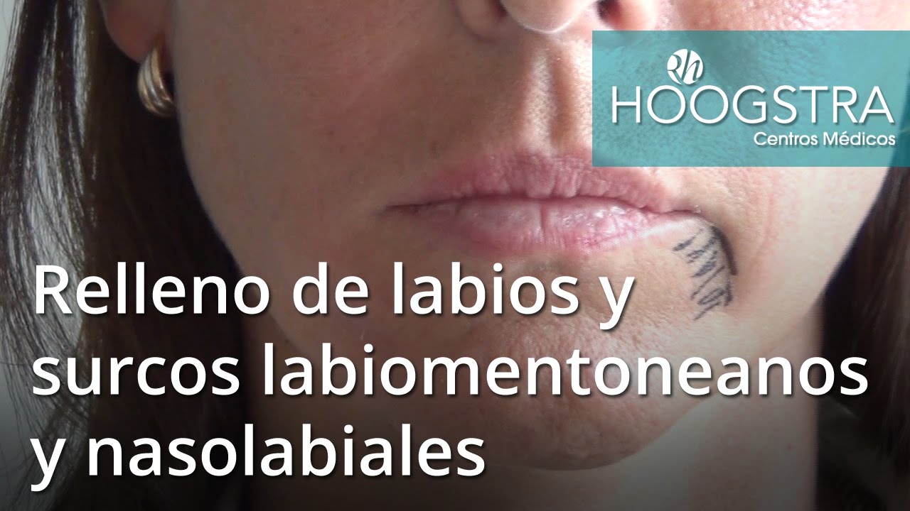 Relleno de labios y surcos labiomentoneanos y nasolabiales (16036 ...