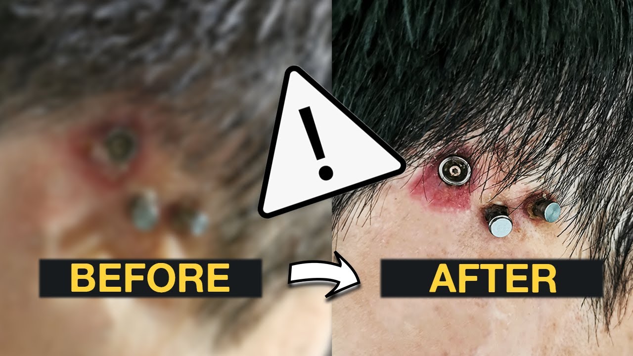 BAHA Infection | Fucidin Cream 100% User Review [CC] - YouTube