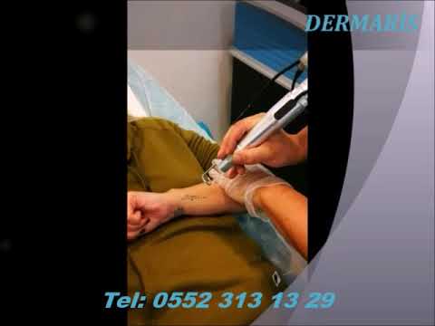 Marmariste dövme ve kalıcı makyajın lazerle silinmesi.Tel: 0552 313 13 29 . Dermarislazer.