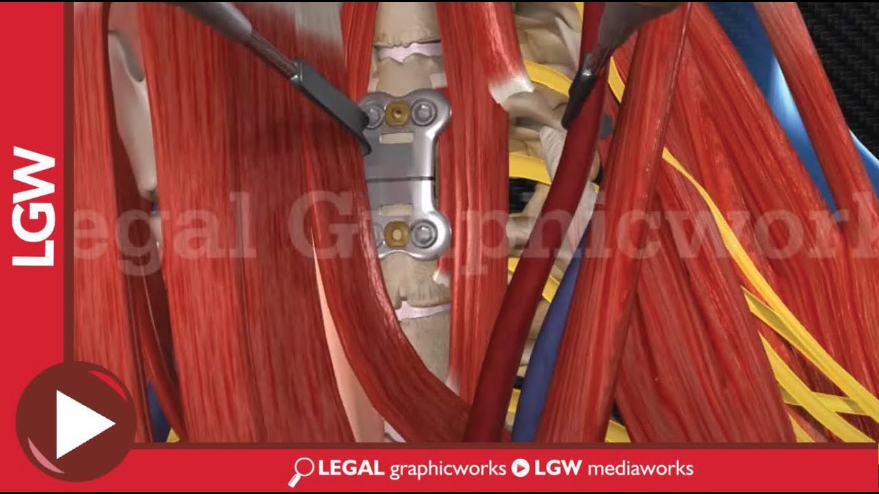 Anterior Cervical Fusion Surgery 3D animation - YouTube