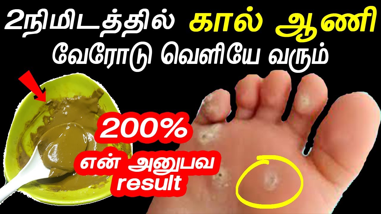 2நிமிடத்தில் கால் ஆணி வேரோடு வெளிய வரும் | kaal aani treatment in tamil ...