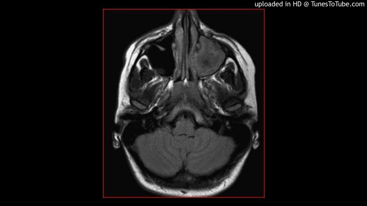 Lithiasis of the Maxillary sinus : Removal of Antrolith and Concomitant ...
