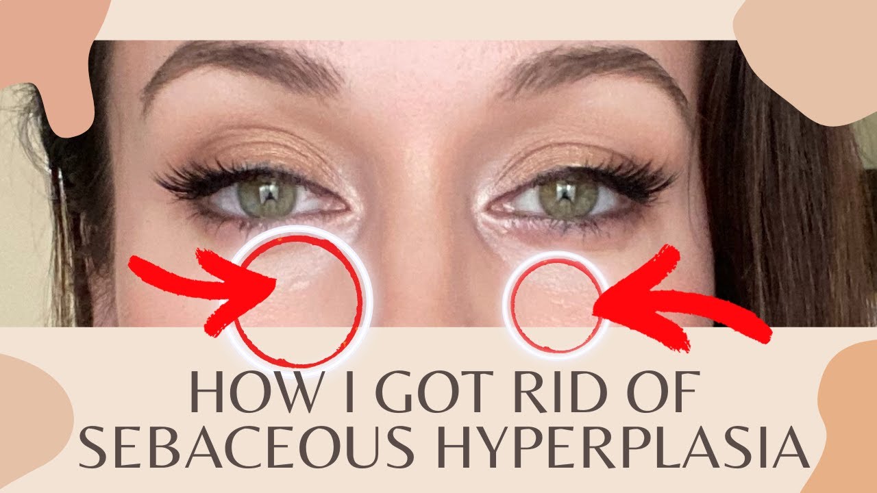 How I GOT RID Of Sebaceous Hyperplasia skin Tags bumps YouTube how-i-got-rid-of-sebaceous-hyperplasia-skin-tags-bumps-youtube