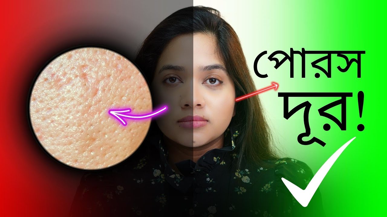 😯 ওপেন পোরস দূর করার নিশ্চিত বৈজ্ঞানিক উপায় । How To Get Rid Of Large ...
