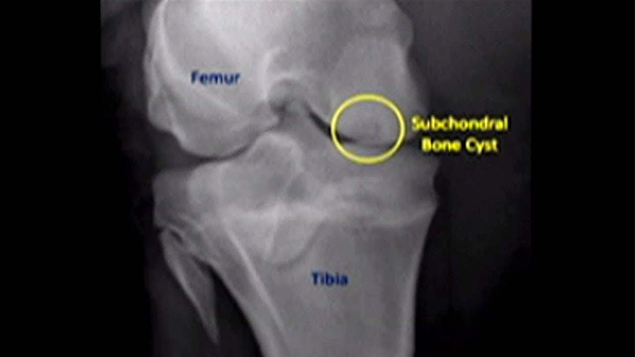 Subarticular Cyst or Subchondral Bone Cyst ; X-rays, Causes, Symptoms ...