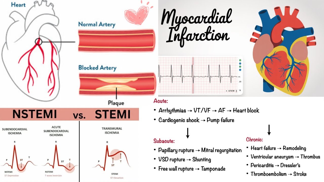 Myocardial Infarction Explained | Causes, Pathophysiology & ECG Changes ...
