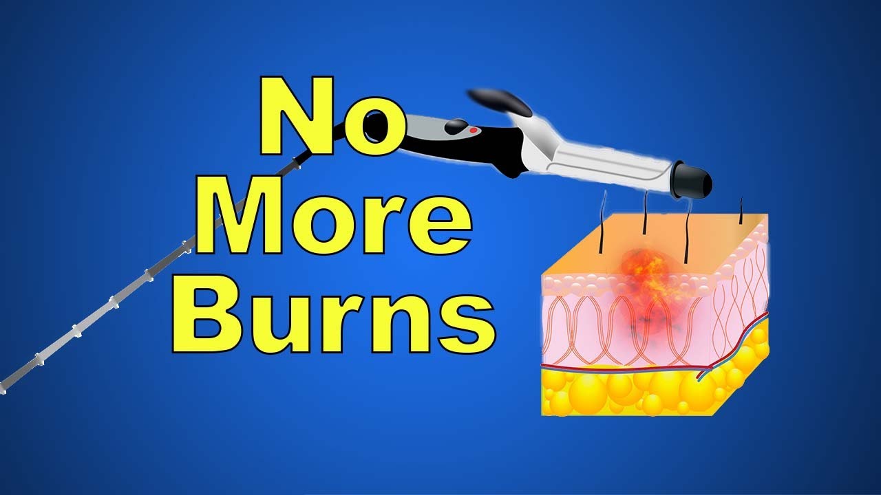 How to Treat Burns - No More Burns - YouTube