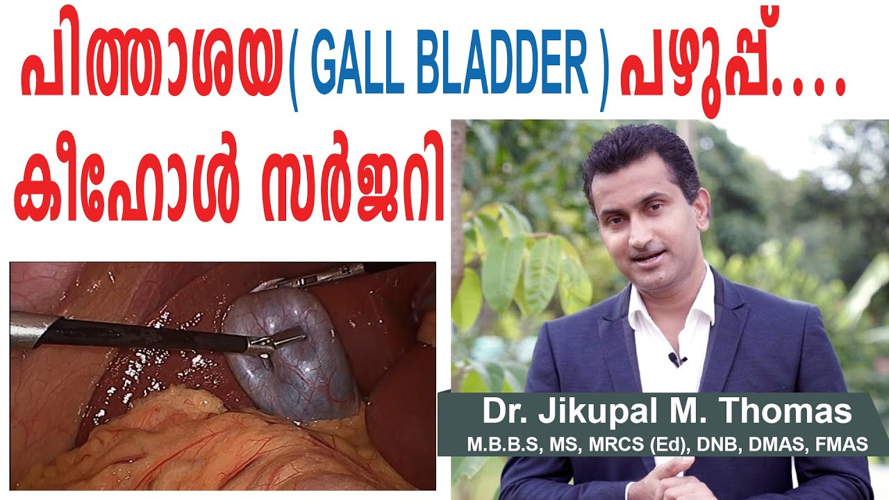 പിത്താശയ (GALLBLADDER) പഴുപ്പ് ... കീഹോൾ സർജറി - YouTube
