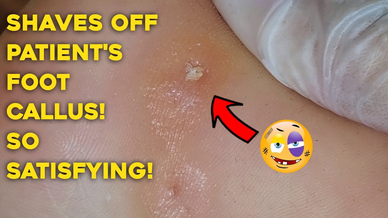 Miss Foot Fixer Shaves Off Patient's Foot Callus! So Satisfying Marion ...