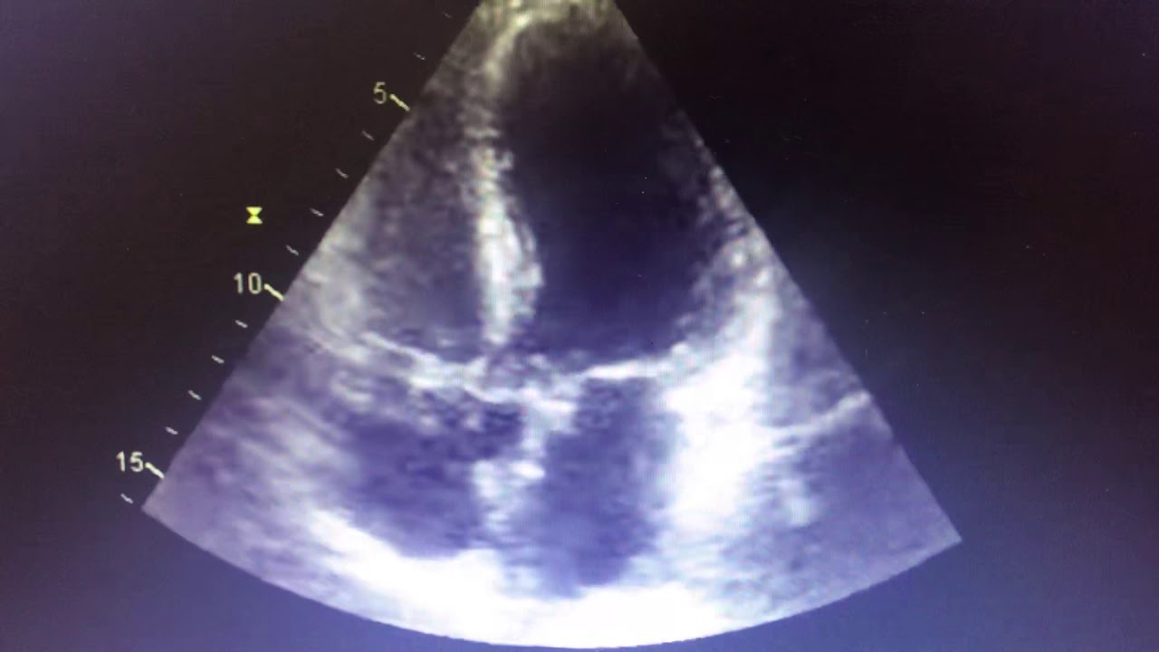Contrast echocardiogram in pulmonary AVM - YouTube