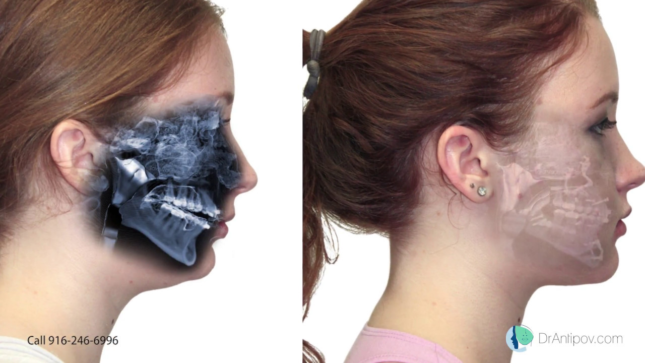 Counterclockwise Rotation Jaw