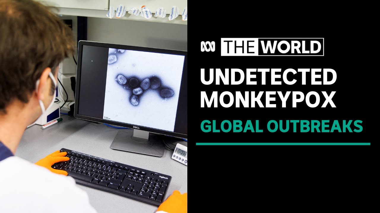 Disease experts say data indicates at least two separate Monkeypox ...