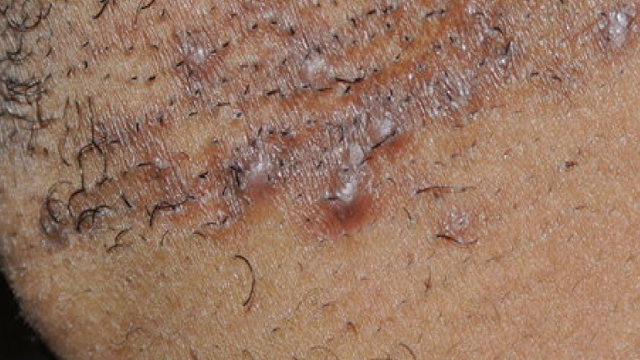 how to get rid of ingrown hairs on back of neck - YouTube