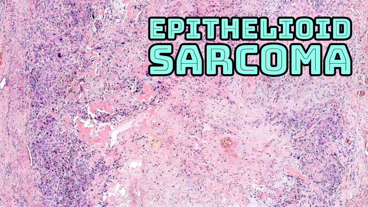 Epithelioid sarcoma under the microscope (pathology histology dermpath ...