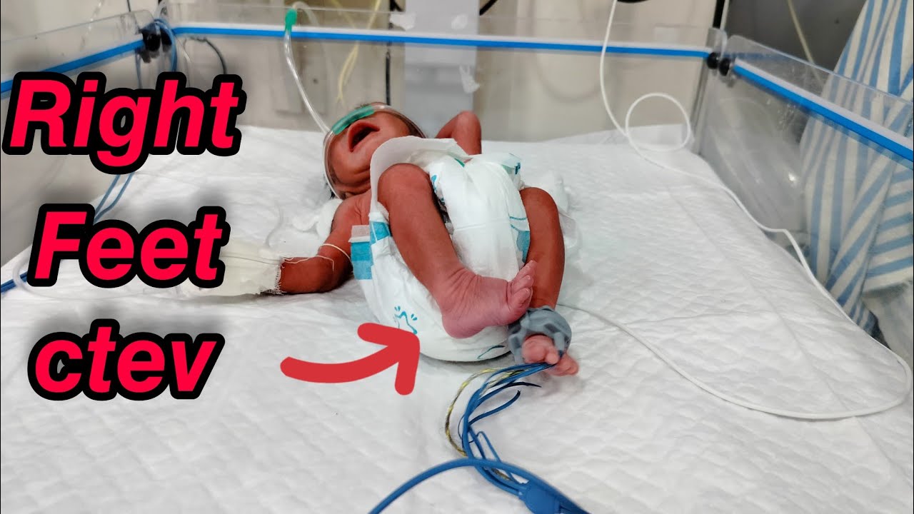 Normal Delivery Newborn Baby || Right Feet CTEV || NICU || Newborn Baby ...