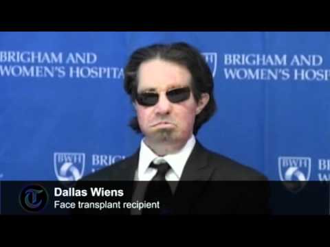 Full face transplant patient speaks out one year on - YouTube