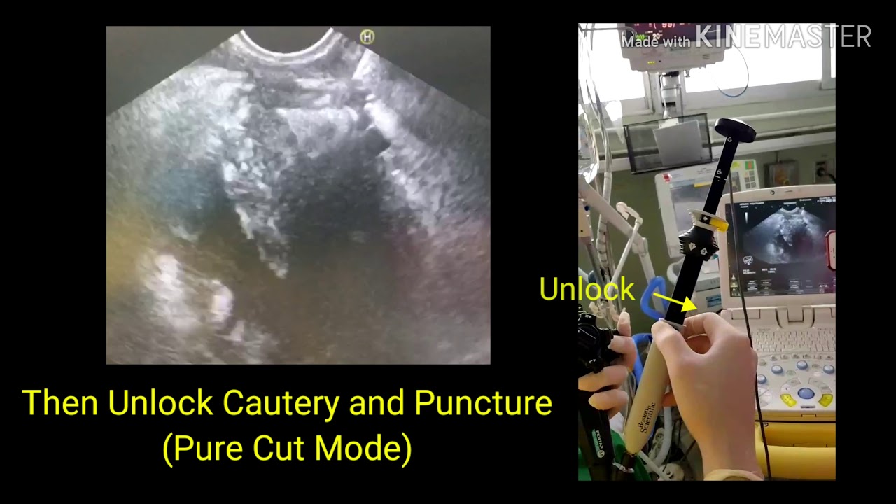 Hot Axios Step by Step in Bedside EUS-Pancreatic Drainage - YouTube