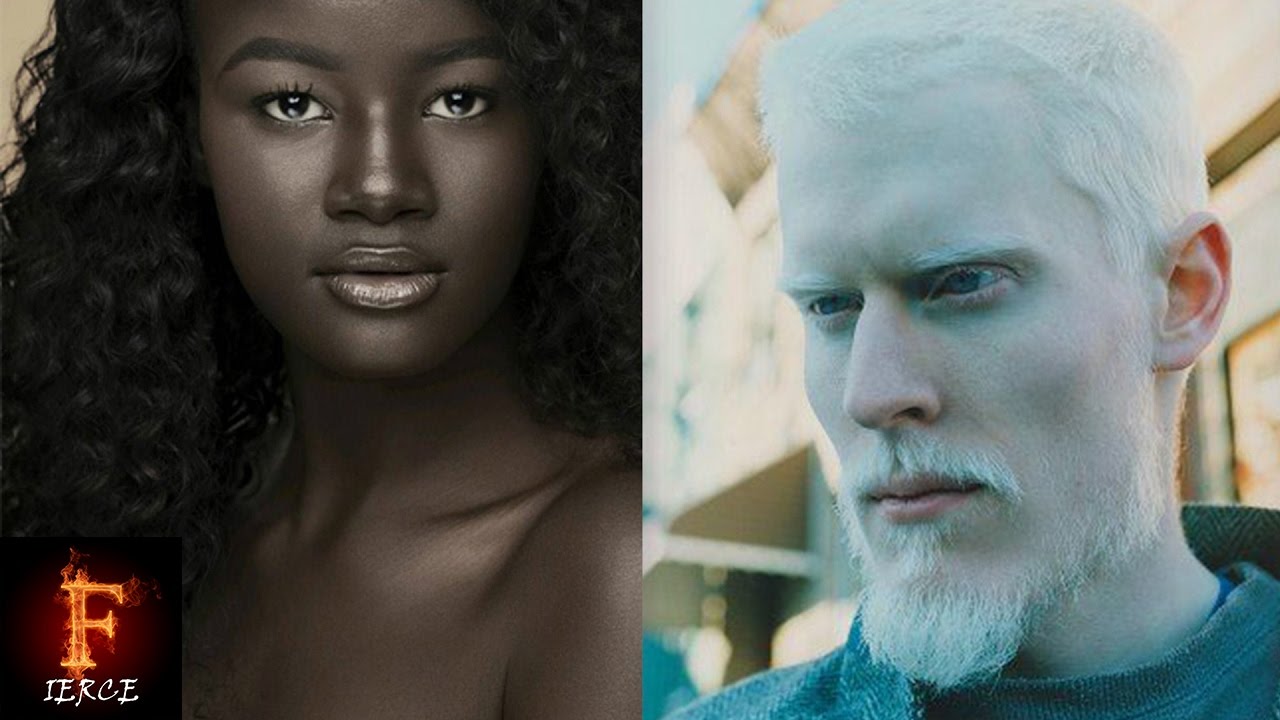 6 People with Unique Skin Color - YouTube