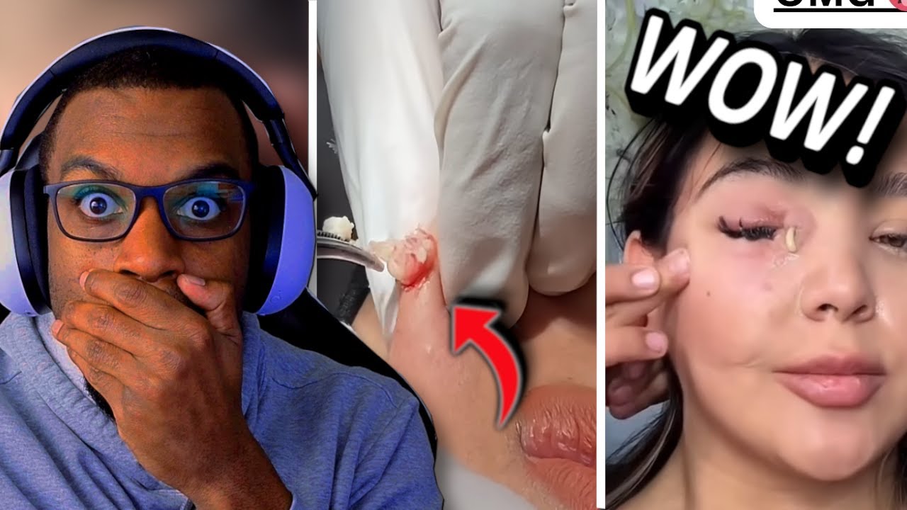 LOOK AT THIS FACE CYST POP!! - YouTube
