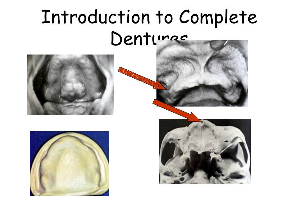 Complete Denture Preliminary Impression - YouTube