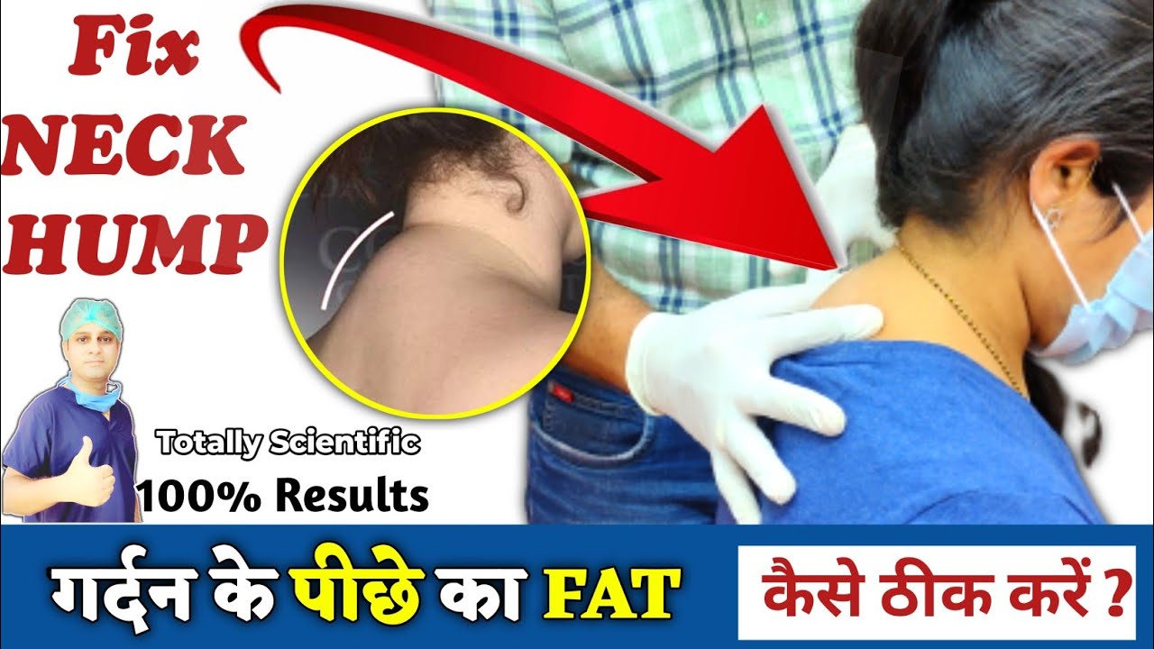 Neck Hump Exercises in Hindi | How to remove fatty Neck Hump | Dowager ...