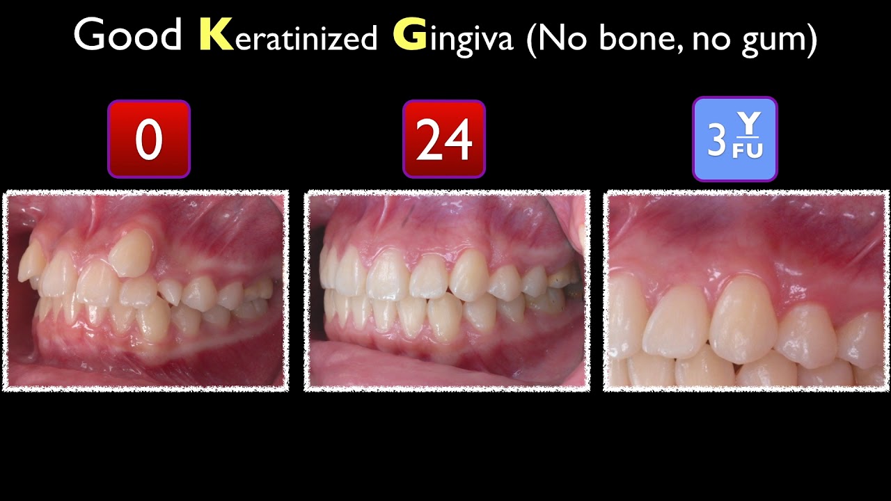 Chris' Top 11 Cases: Canine-Lateral Incisor Transposition｜【Chris Chang ...
