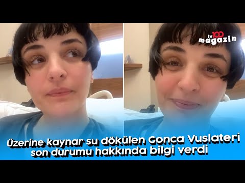 Üzerine kaynar su dökülen Gonca Vuslateri son durumu hakkında bilgi verdi