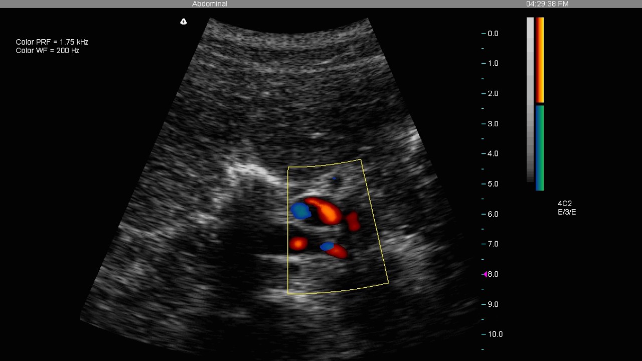 Ilo epatico - Mickey sign - ecocolorDoppler - YouTube