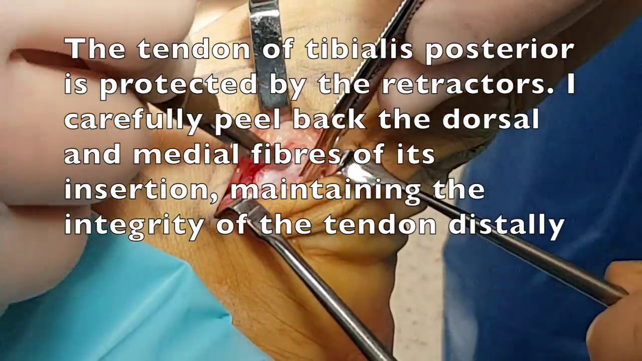 Kidner Procedure - YouTube