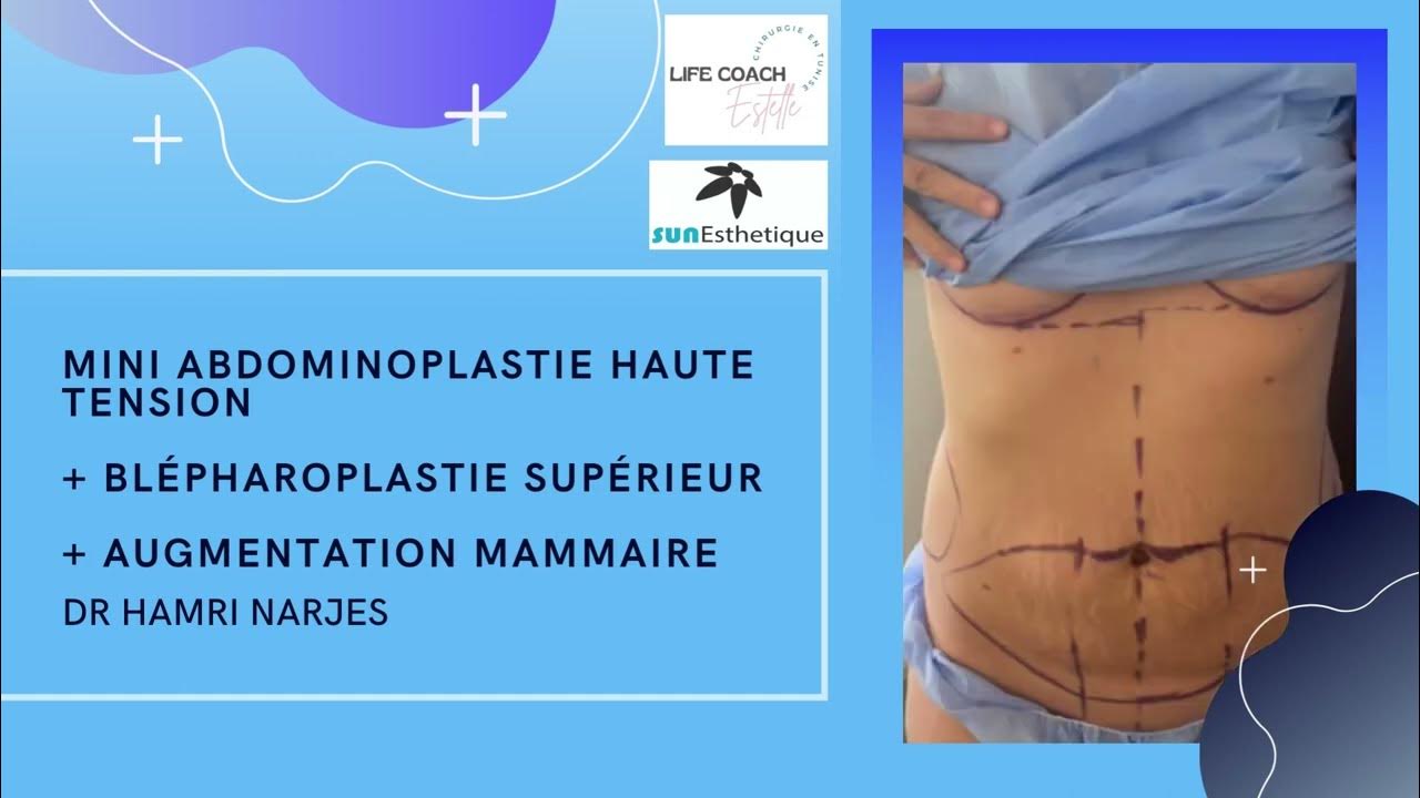 Mini abdominoplastie + Blépharoplastie supérieur + Augmentation mammaire / Dr Hamri Narjes - YouTube