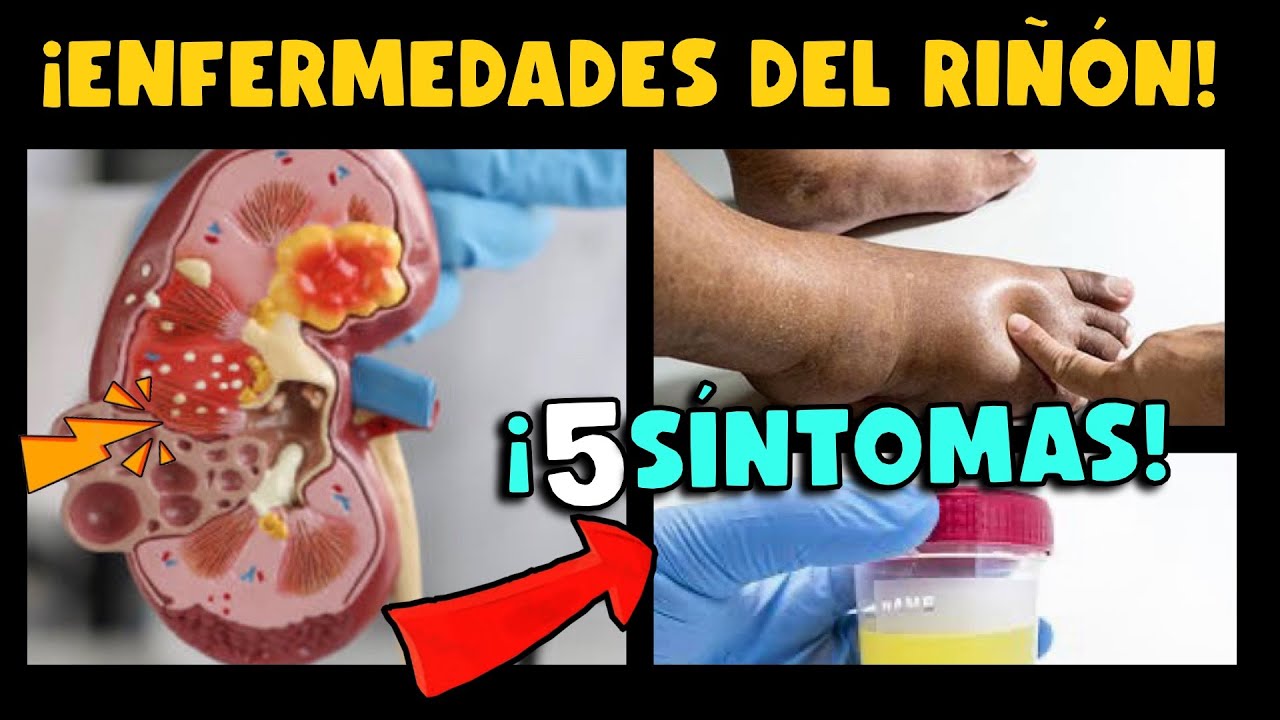 CUIDADO ⚠️ CAMBIOS EN LA ORINA Y ENFERMEDADES DEL RIÑON - YouTube