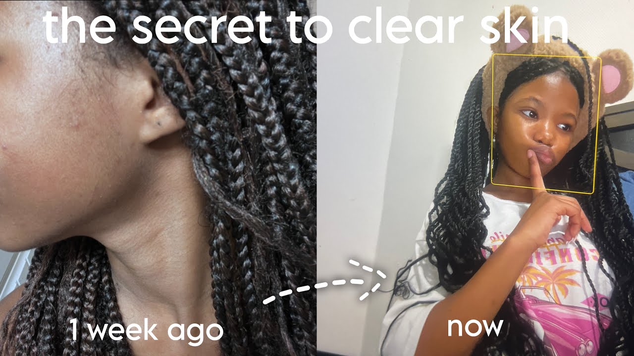 how to clear your skin & get rid of acne in less than 6 minutes - YouTube