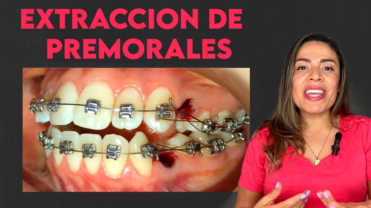 Guía completa sobre extracciones :lo que debes saber antes, durante y ...