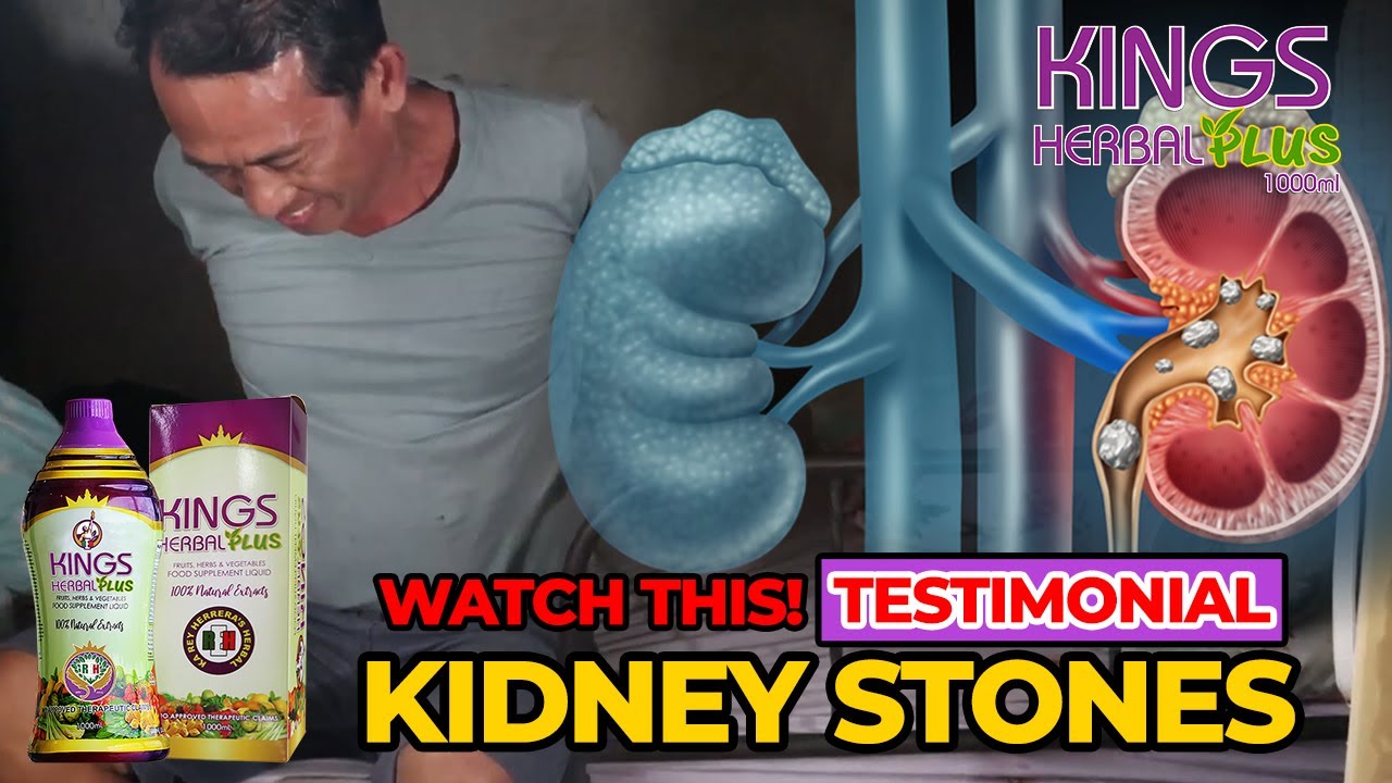 Kidney Stones Problem - KINGS Herbal Plus Testimonial - YouTube