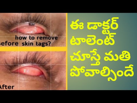 How To Remove Skin Tags On eyelids With Laser? - YouTube