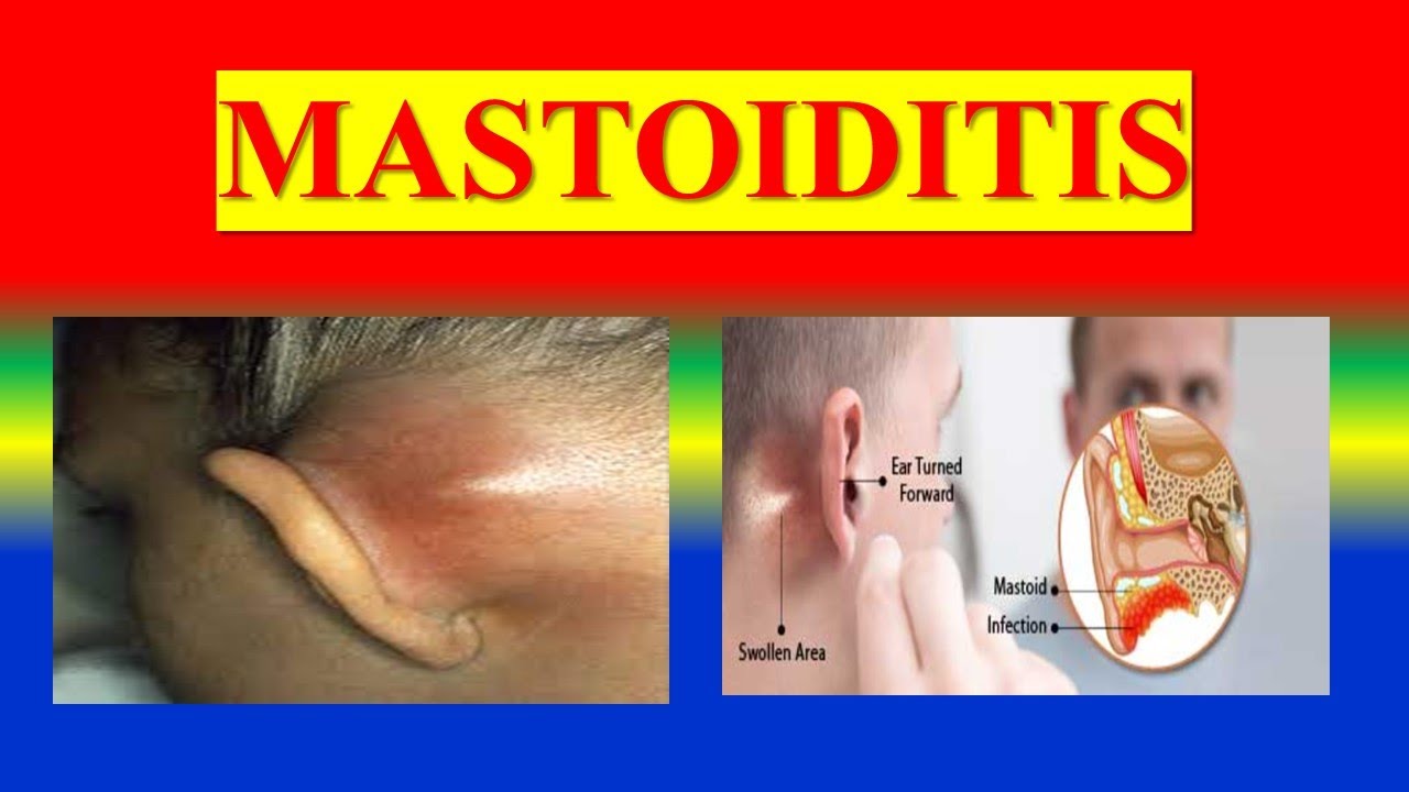 MASTOIDITIS - define , classification , pathophysiology , clinical , diagnostic , management ...