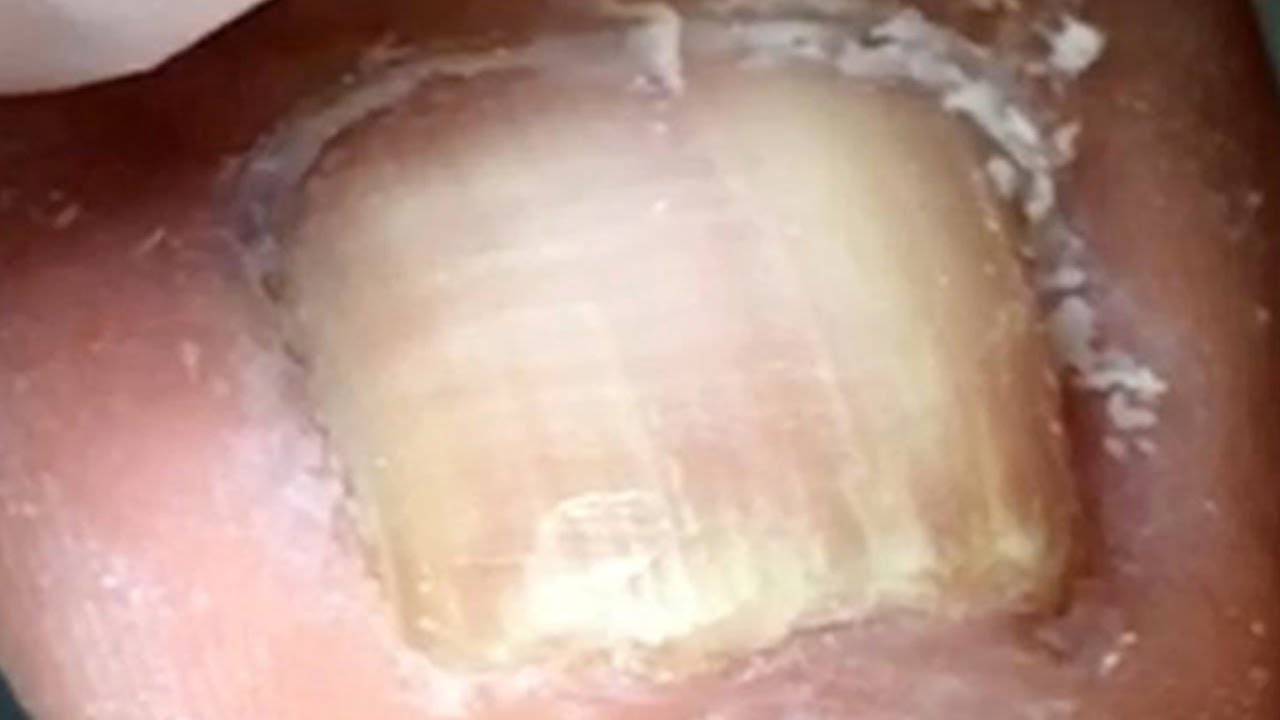 During square toenail trimming, remove dead skin【Crazy pedicure room ...