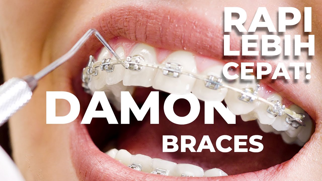 DAMON BRACES, CARA MERAPIKAN GIGI CEPAT DAN AMAN! - YouTube