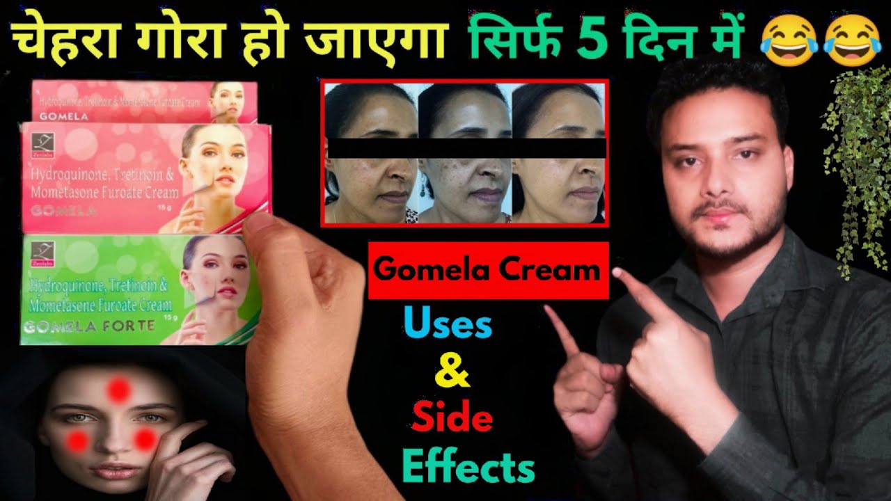 Gomela skin cream||uses & side effects full review in hindi||Gomela ...