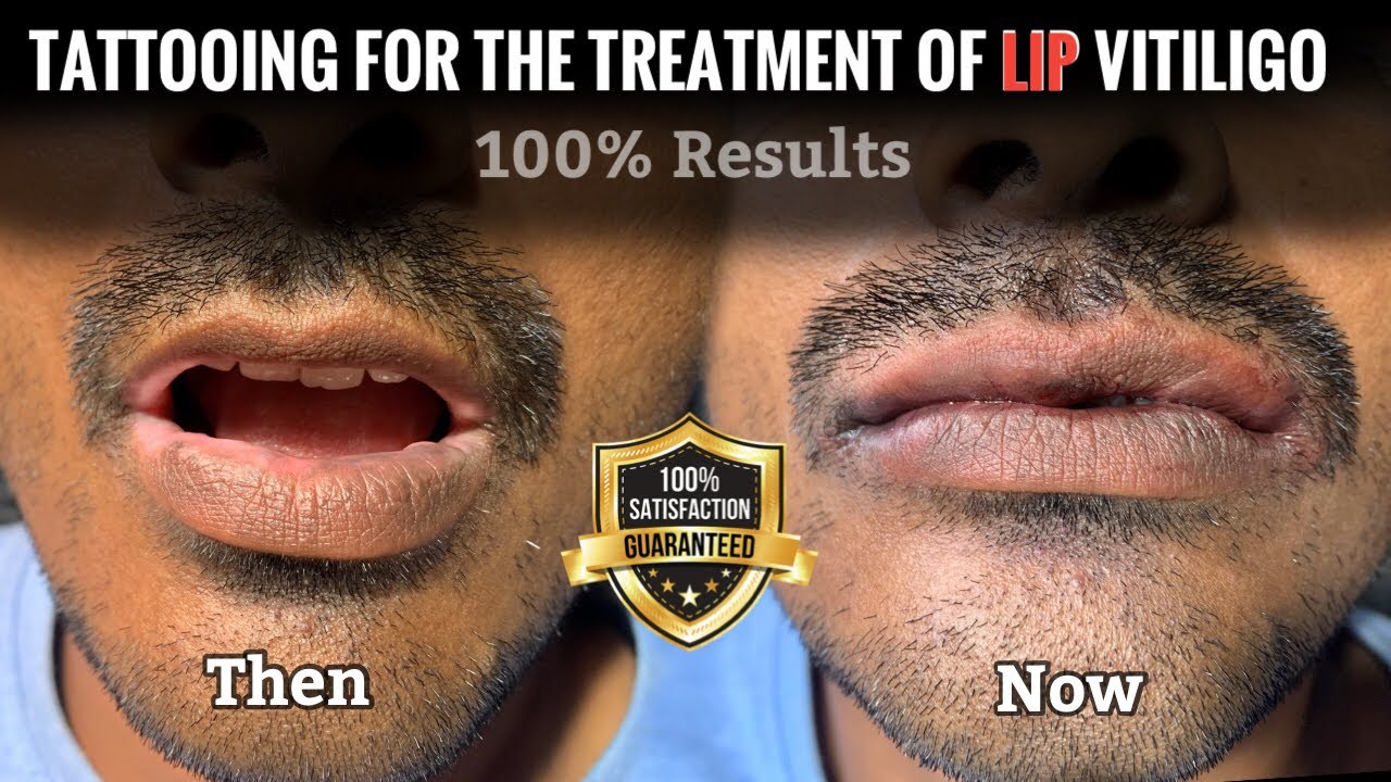 Tattooing for the treatment of lip vitiligo | 100% results | contact no ...
