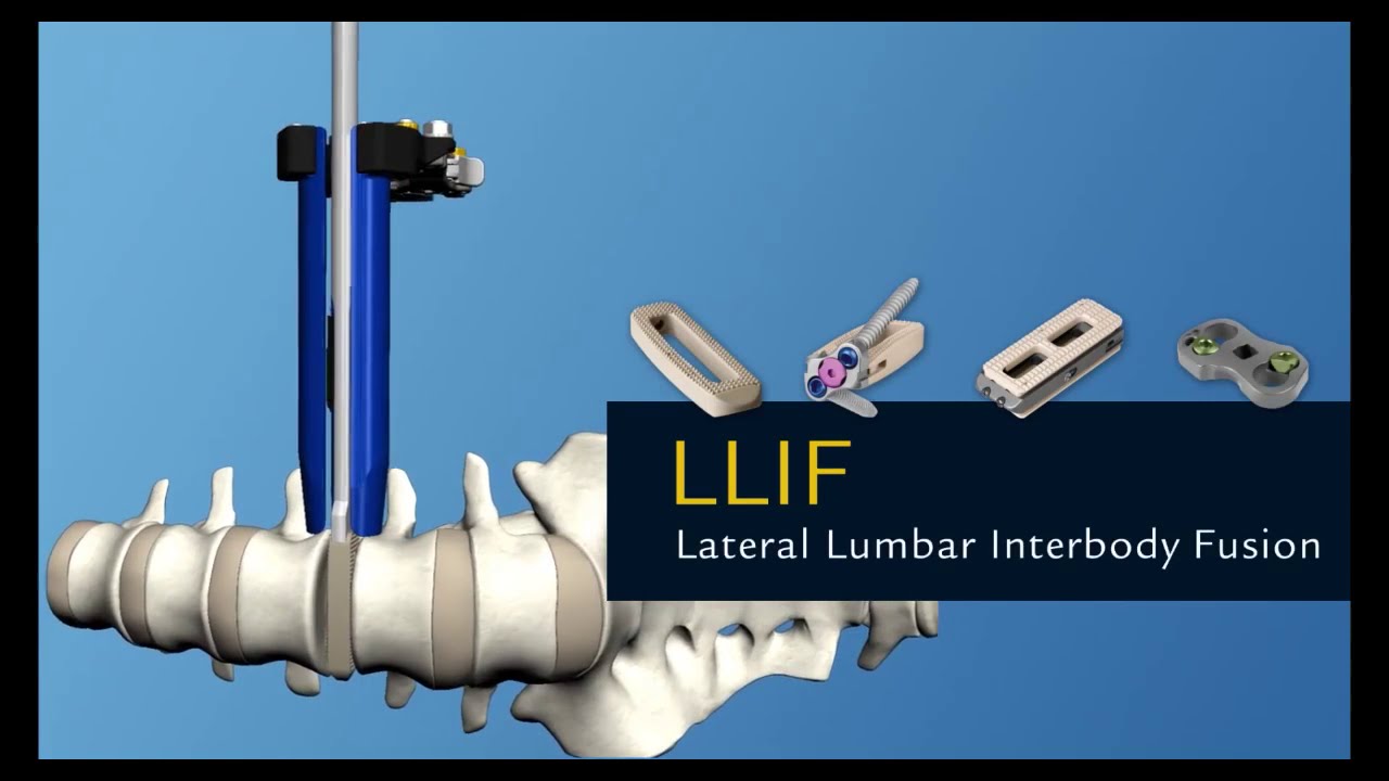 Globus Medical: LLIF Technique - YouTube