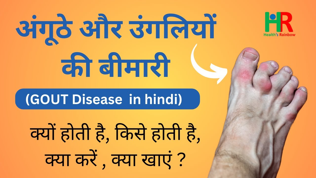 Gout symptoms causes diagnosis treatment and diet | अंगूठे और उंगलियों ...