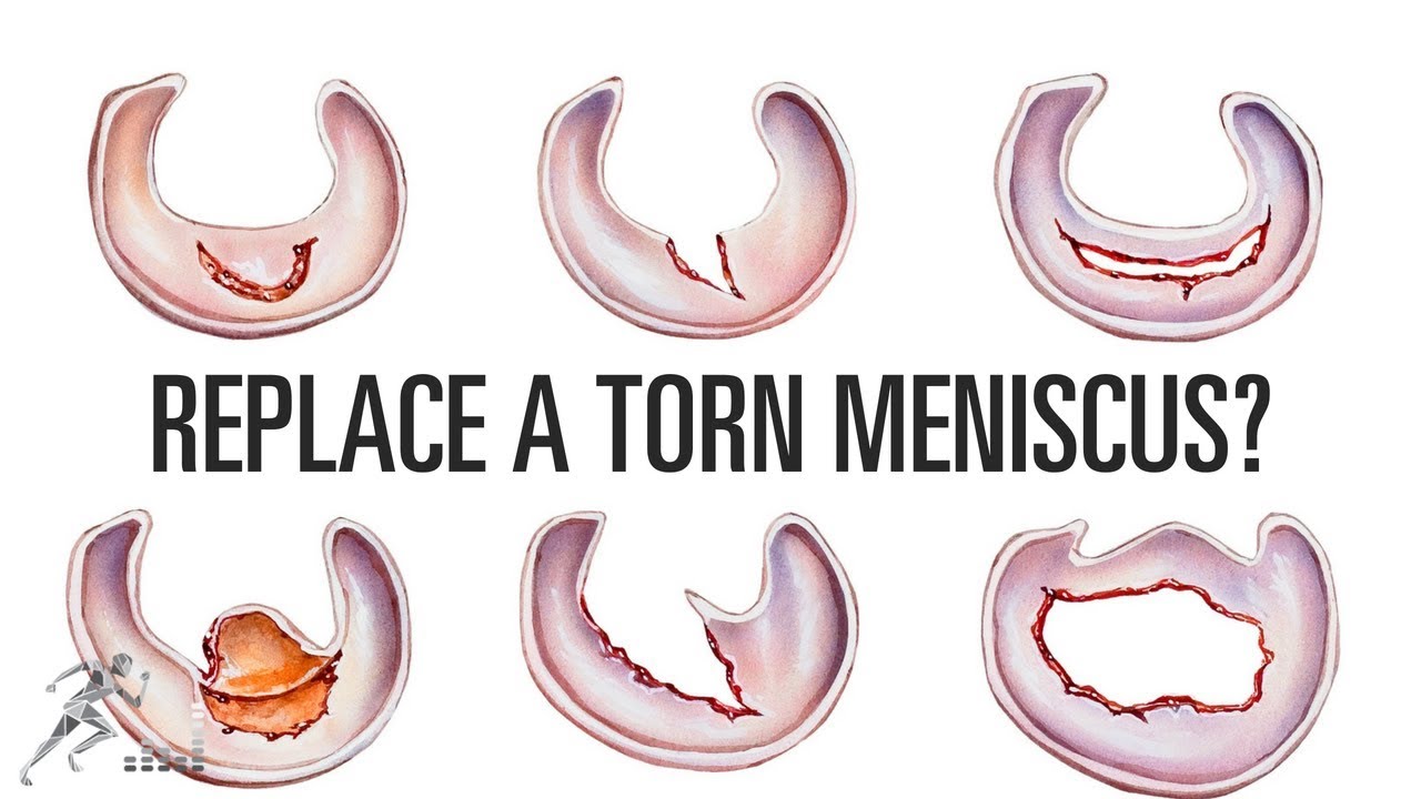 Is it possible to replace a meniscus tear trimmed out at surgery? - YouTube