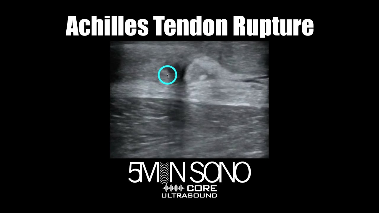 5 Minute Sono: Use POCUS to find Achilles tendon ruptures after ...