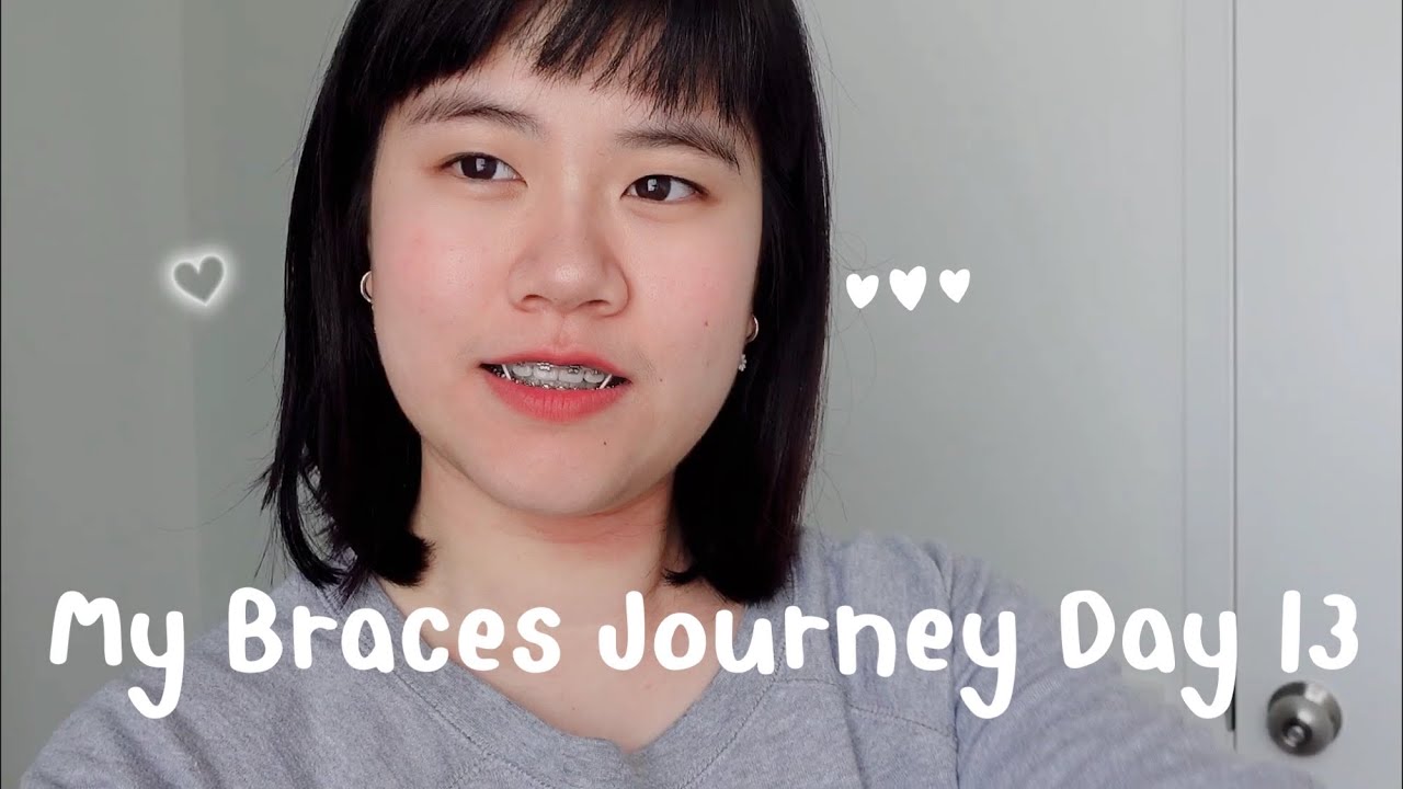 My Braces Adjustment Day 13 It's Official! Exciting news! My dentist’s ...
