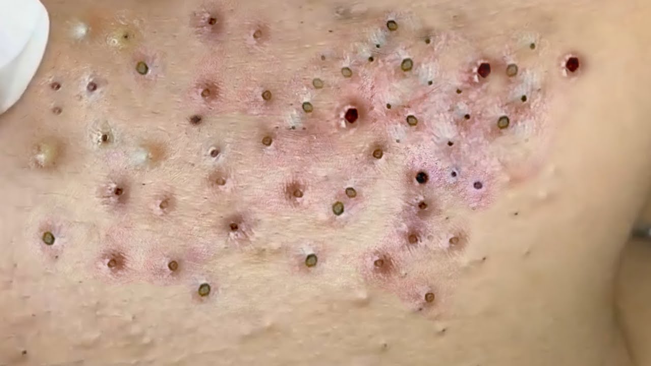 Blackhead Treatment for patients at Sac Dep Spa - YouTube