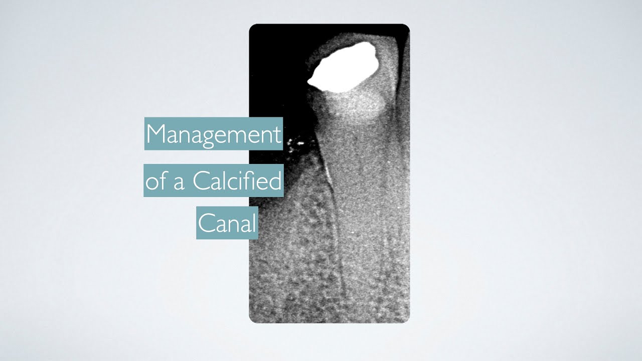 Management Of Calcified Root Canal YouTube management-of-calcified-root-canal-youtube
