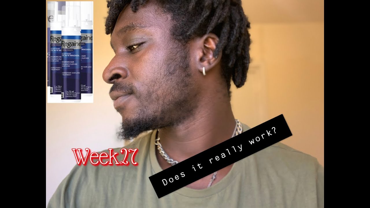 6 Month Minoxidil Beard Journey Week27 Youtube